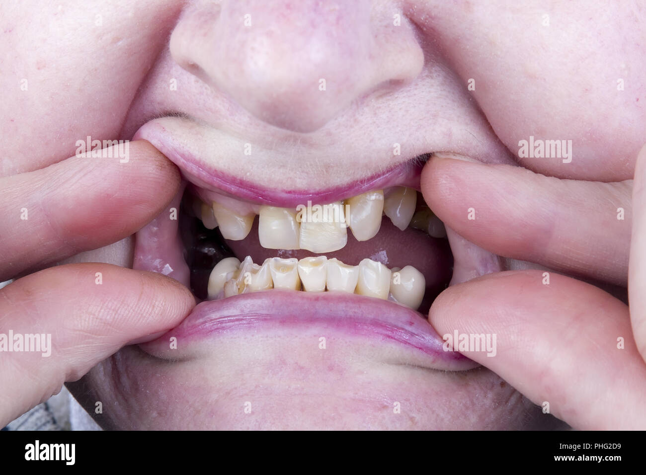 Defective teeth hi-res stock photography and images - Alamy