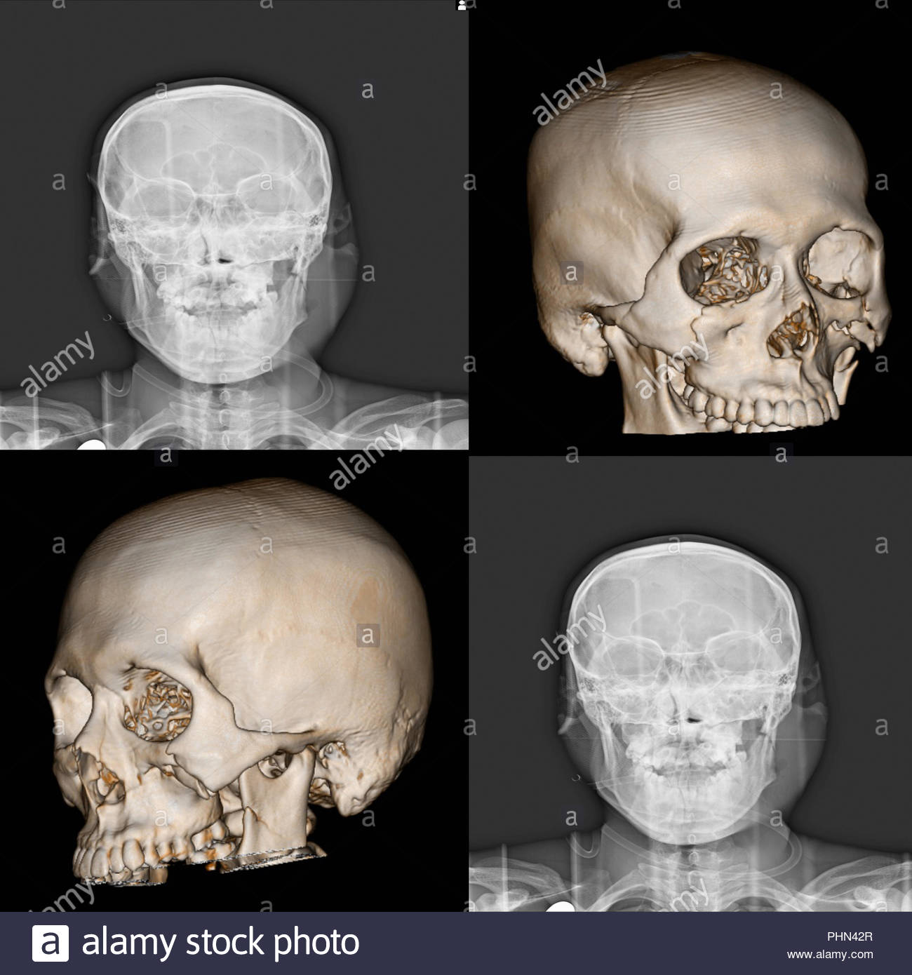 Fractured Skull Stock Photos & Fractured Skull Stock Images - Alamy
