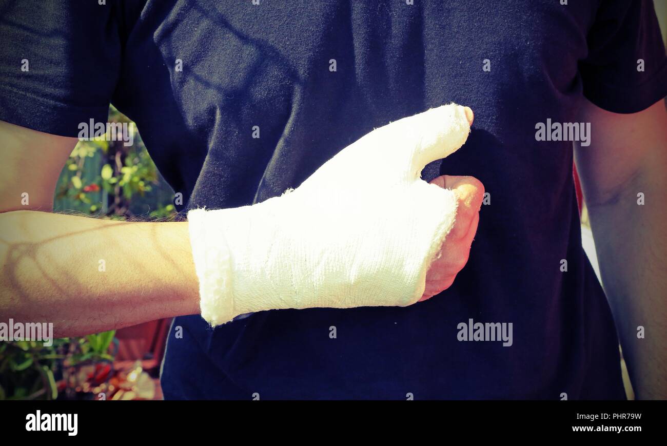 fractured hand of the man with the orthopedic plaster cast at the ...