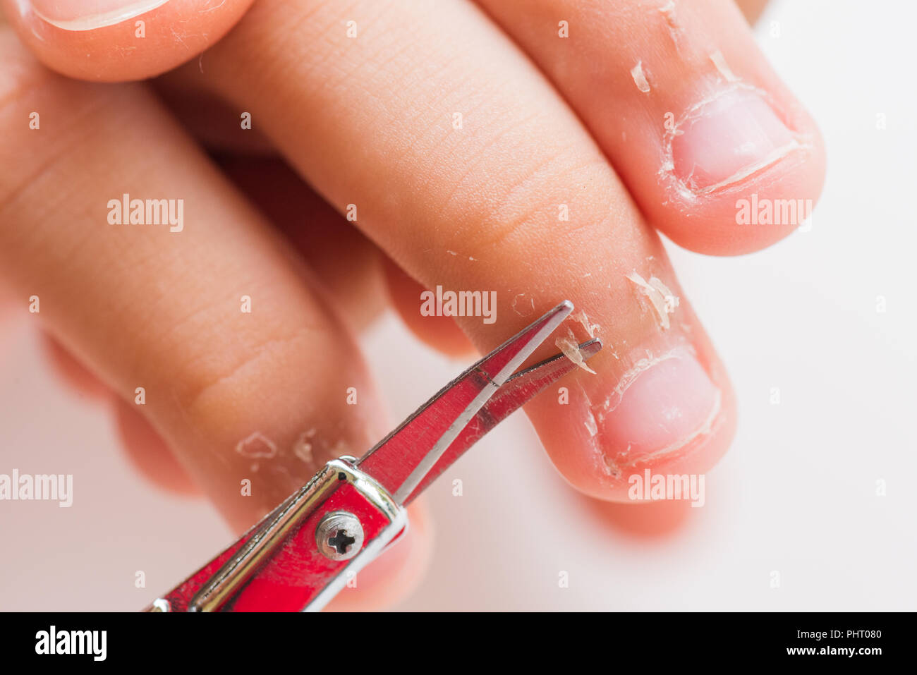 Close up mother using scissors cut dry skin on child's fingers, Eczema ...