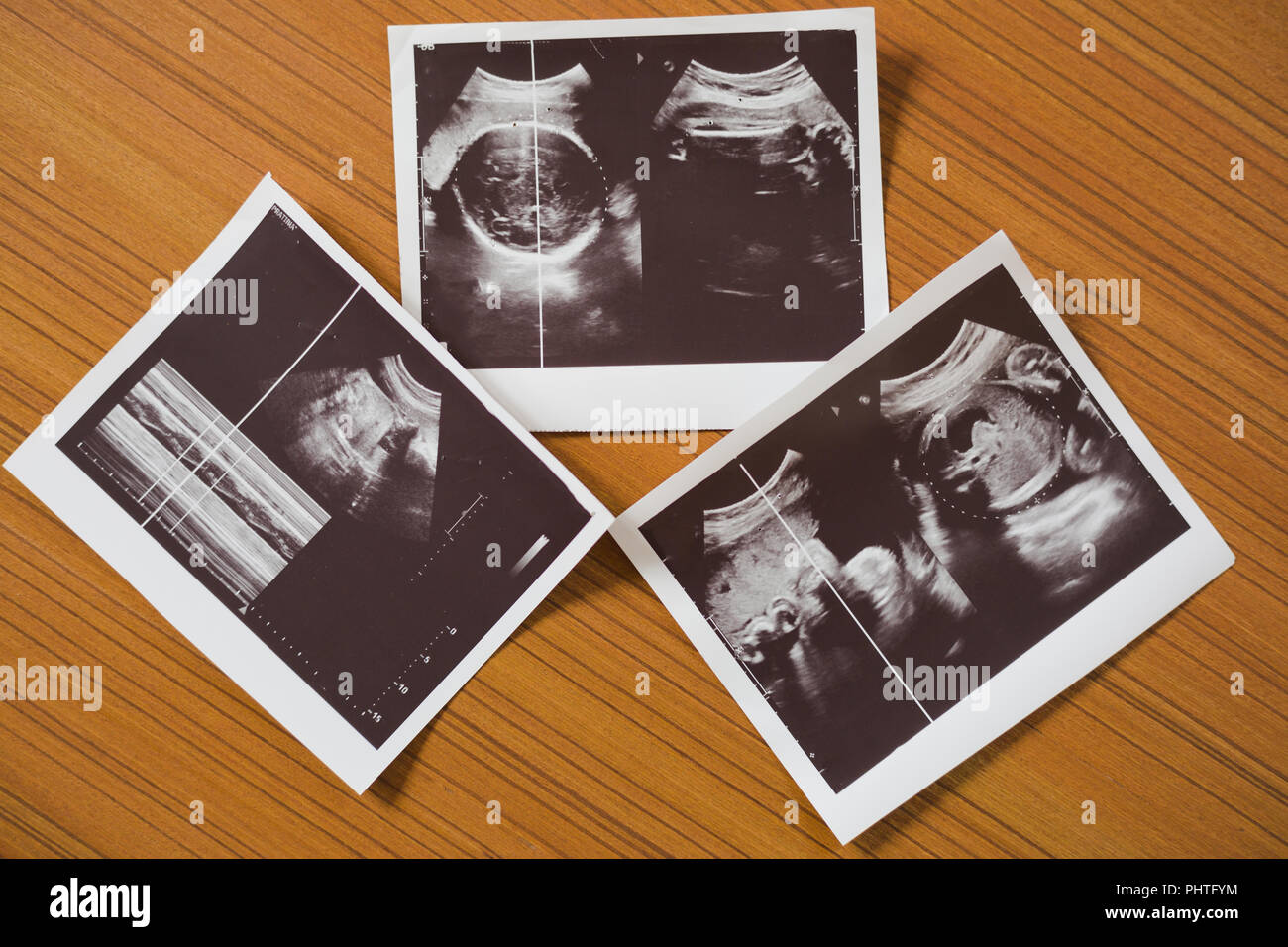 Sonography report hi-res stock photography and images - Alamy