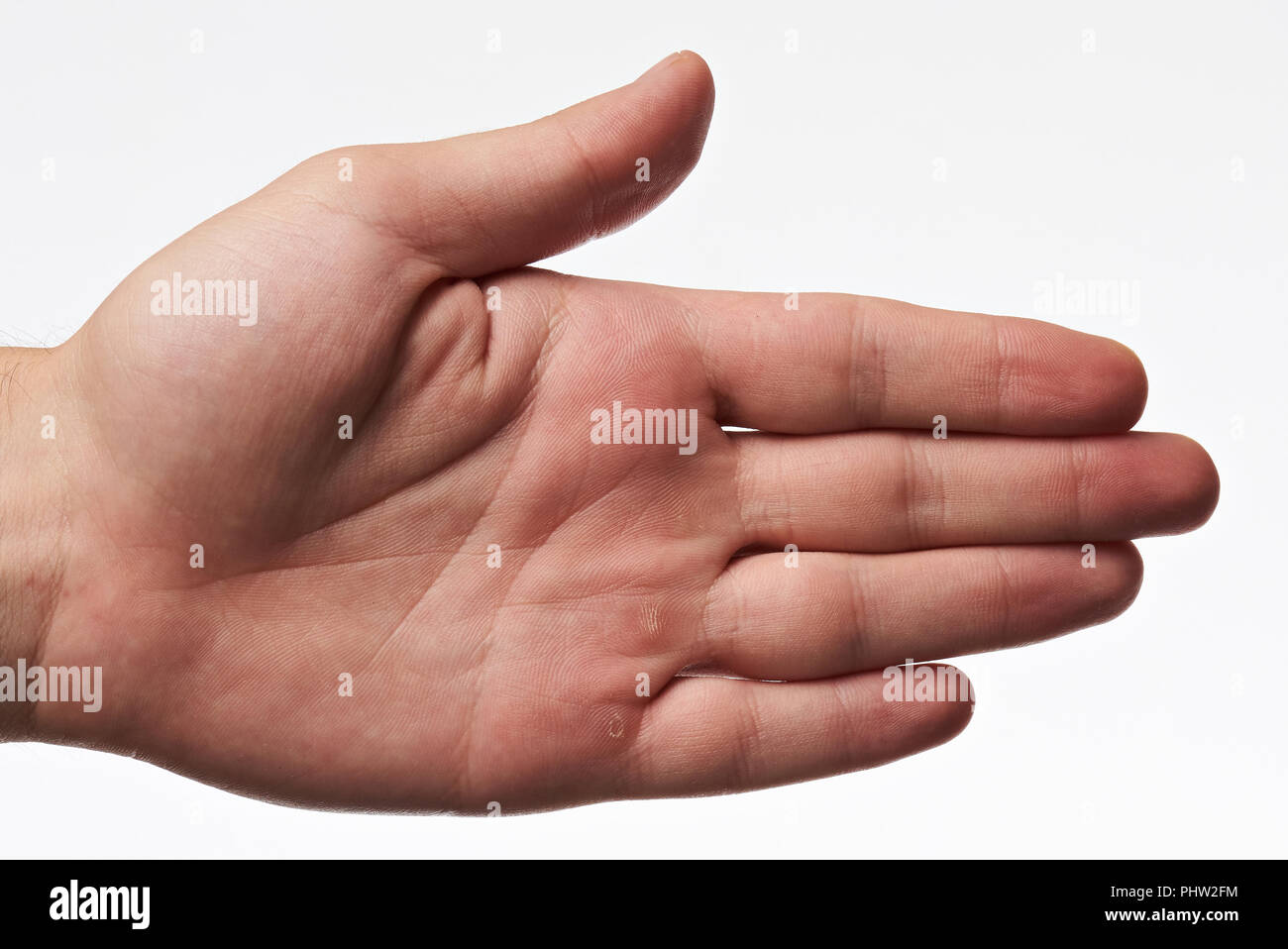 Blister on palm of hand hi-res stock photography and images - Alamy