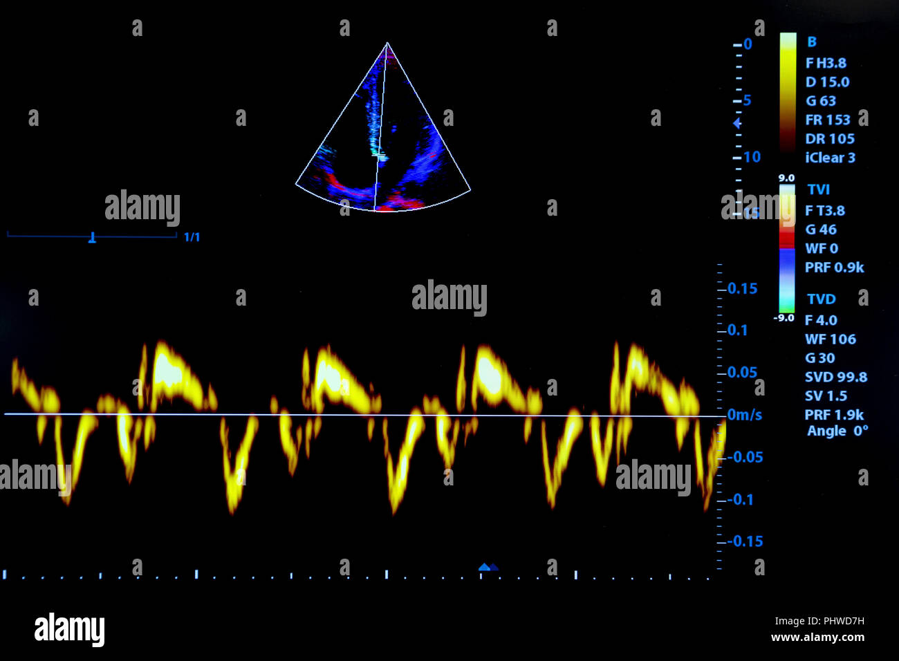 Ultrasound heart chambers hi-res stock photography and images - Alamy