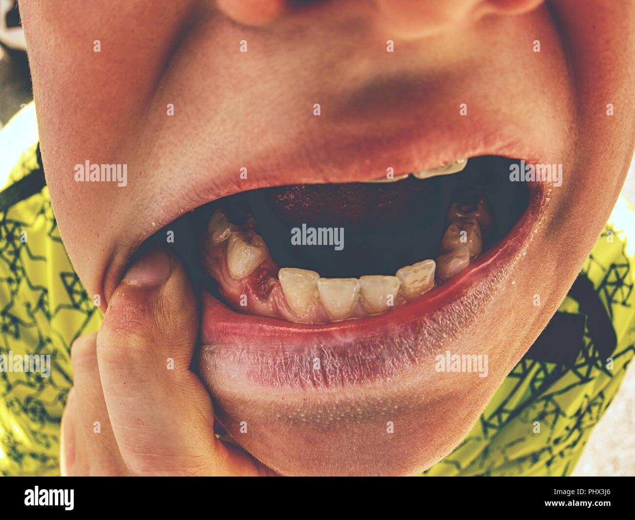 Human Canine Tooth High Resolution Stock Photography and Images - Alamy