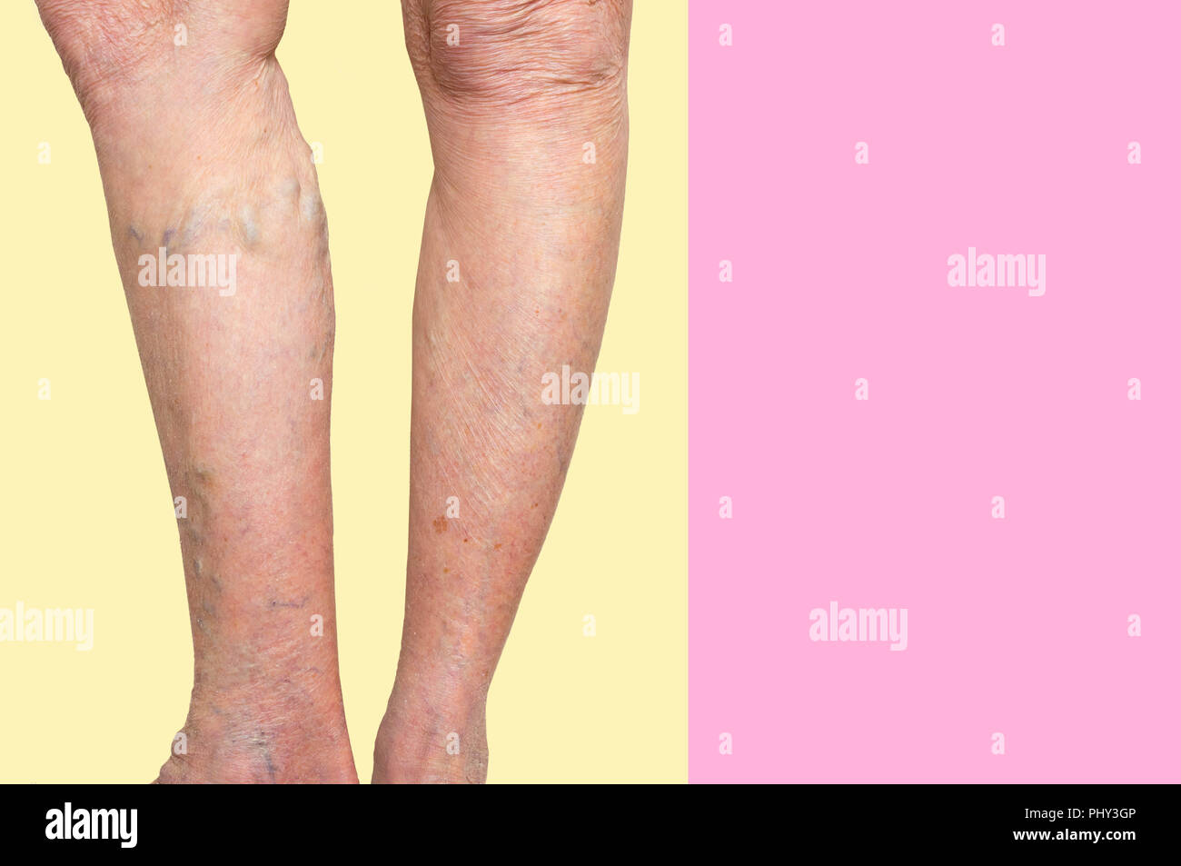 Varicose veins on a female legs Stock Photo - Alamy
