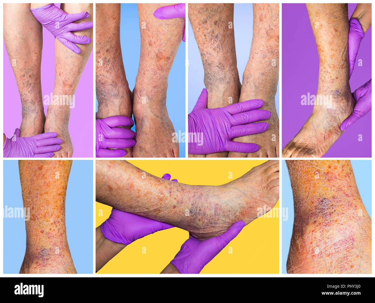 Skin close up vein hi-res stock photography and images - Alamy