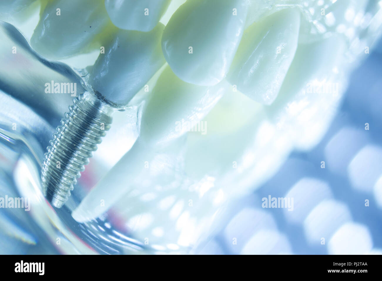 Dental titanium aesthetic orthodontic tooth implant in dentists mouth ...