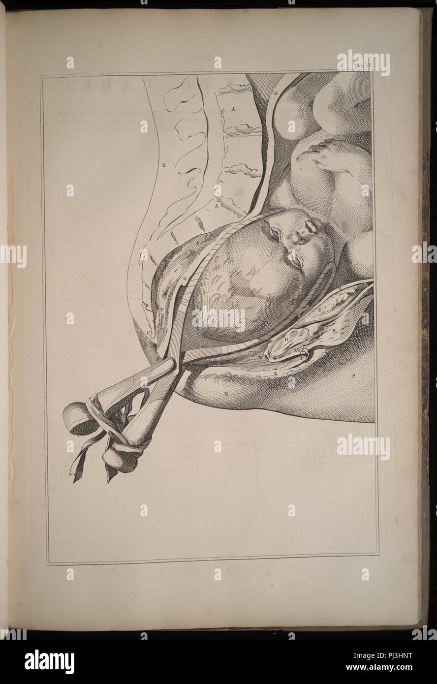 Forceps baby hi-res stock photography and images - Alamy