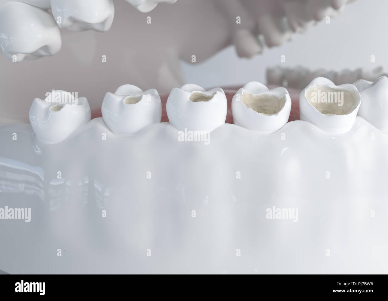 The stages of caries on the molar - 3D Rendering Stock Photo - Alamy