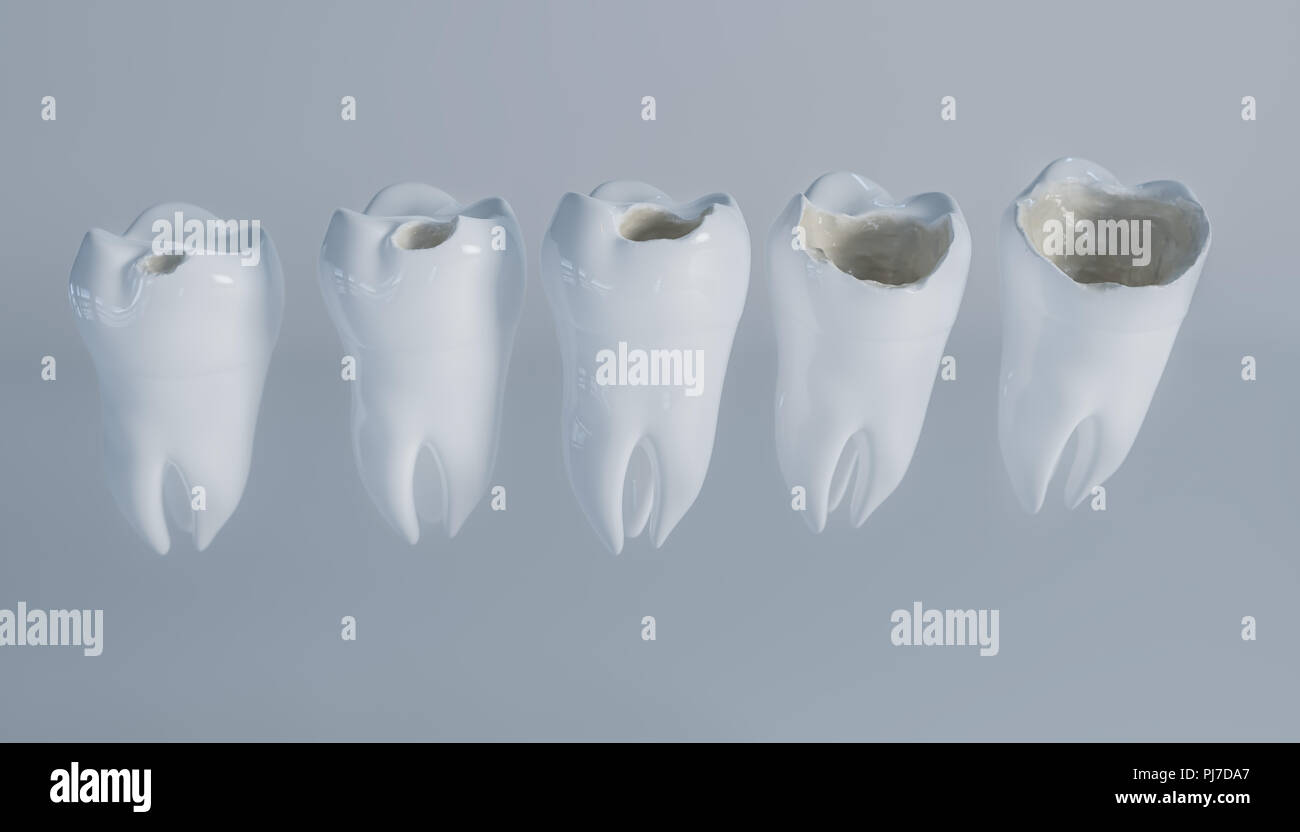 The stages of caries on the molar -- 3D Rendering Stock Photo - Alamy