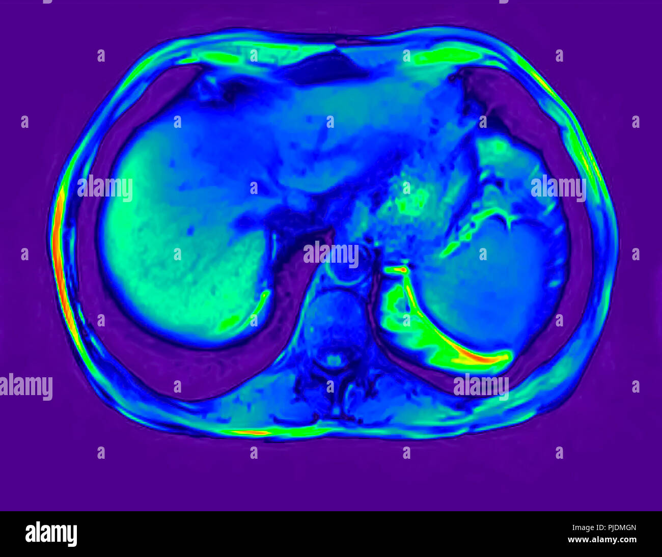 Cross section abdomen MRI scan of 60 year old male patient with kidney ...