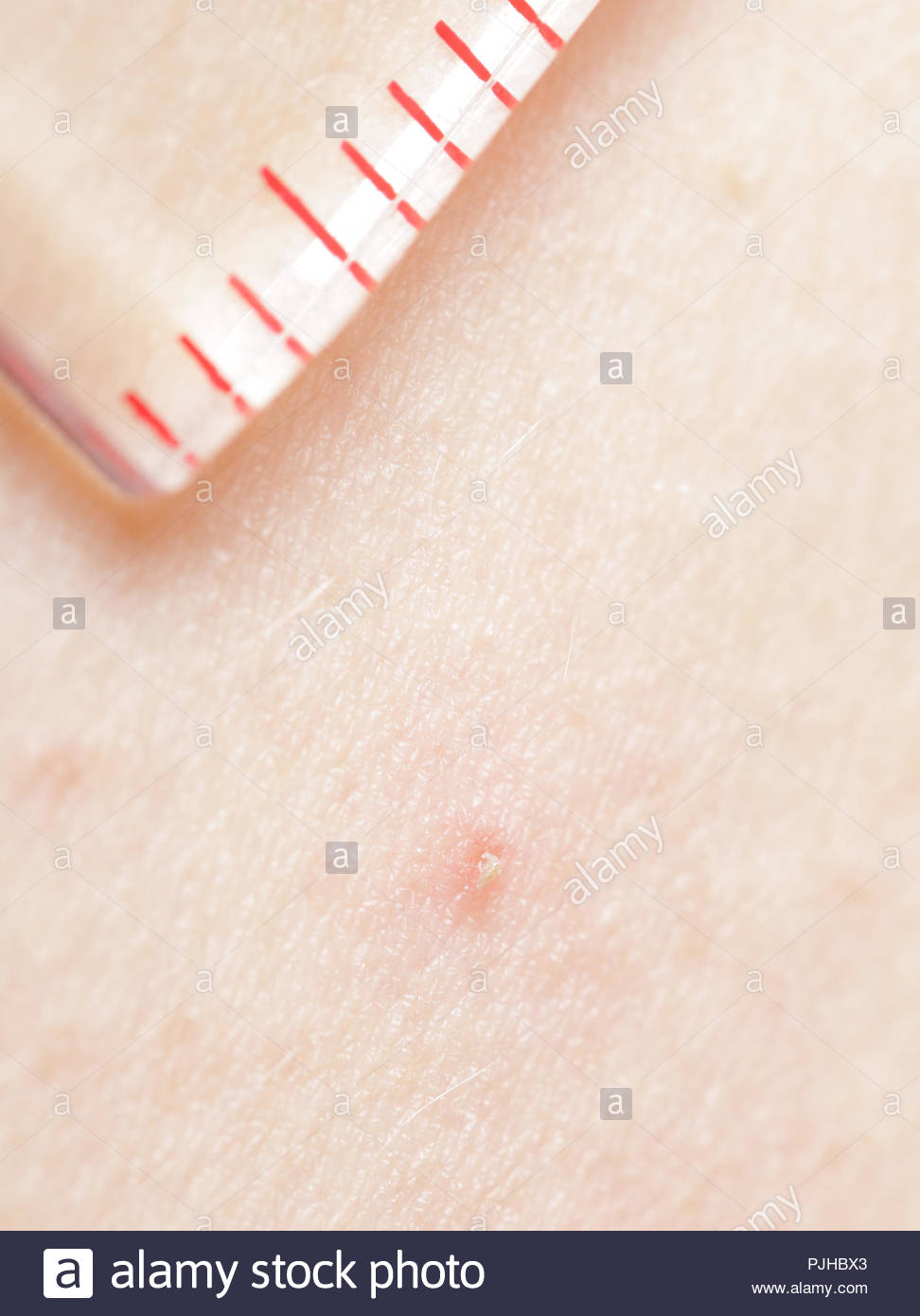 Scabies Human Skin Stock Photos & Scabies Human Skin Stock Images - Alamy