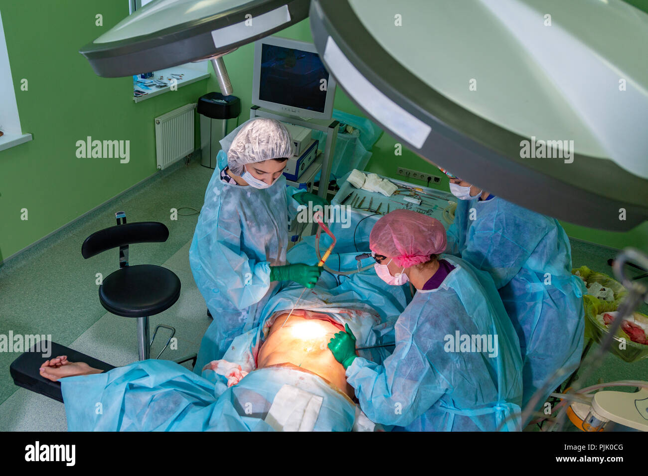 cosmetic liposuction surgery in actual operating room, group of ...