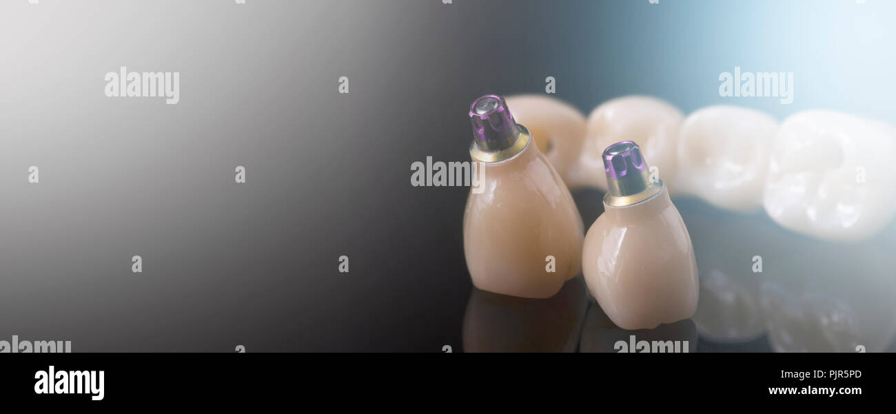 Tooth human implant. Dental concept. Ceramic human teeth or dentures ...