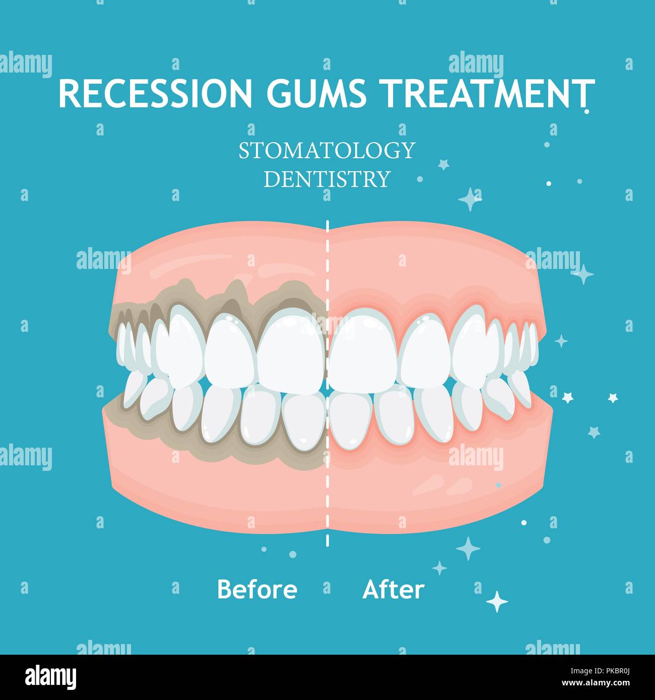 Gum Disease Stock Photos & Gum Disease Stock Images - Alamy