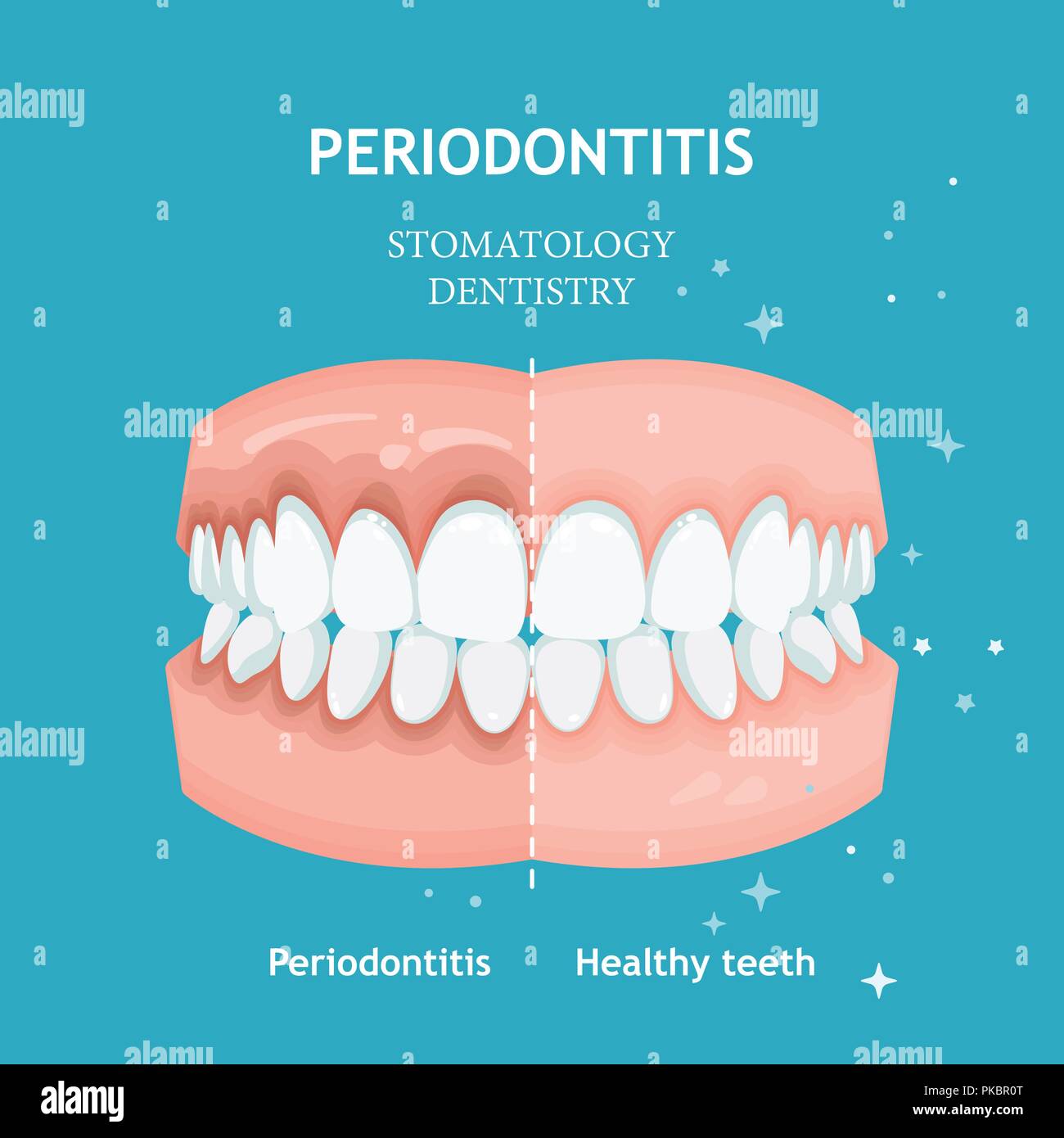 Gum Disease Stock Photos & Gum Disease Stock Images - Alamy