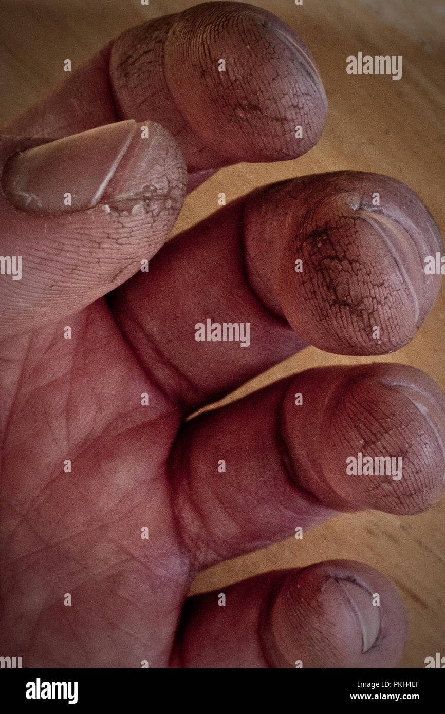 Damaged Skin Working Hand Stock Photo - Alamy