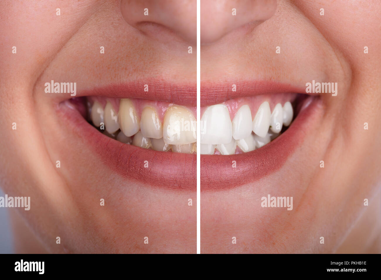 Skin bleaching before after hi-res stock photography and images - Alamy