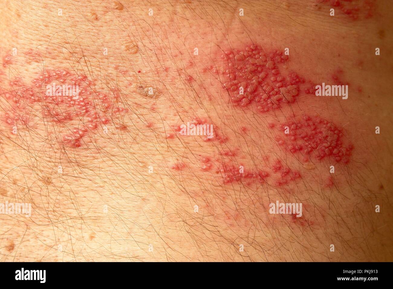Shingles Rash On Leg
