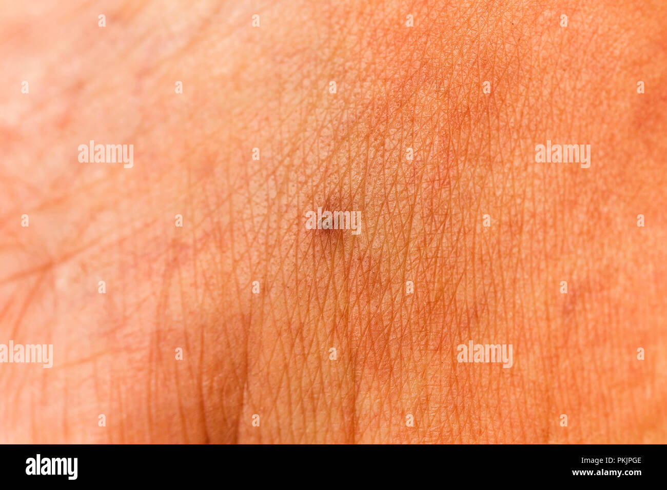 Care body cancer skin human hi-res stock photography and images - Alamy