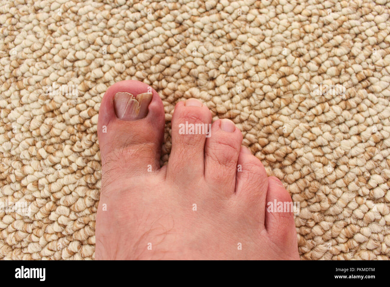 Big toe fracture hi-res stock photography and images - Alamy