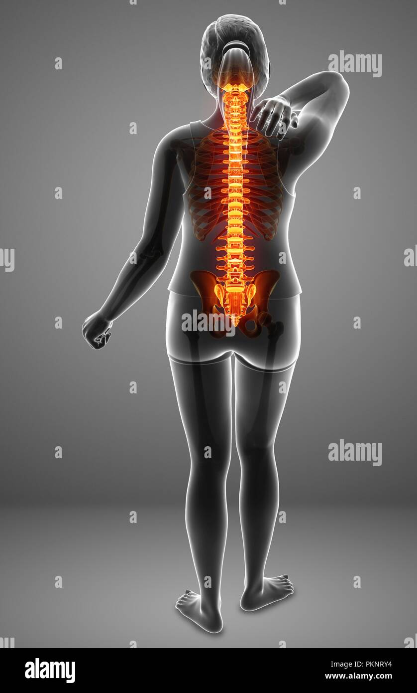 Woman with back pain, computer illustration Stock Photo - Alamy