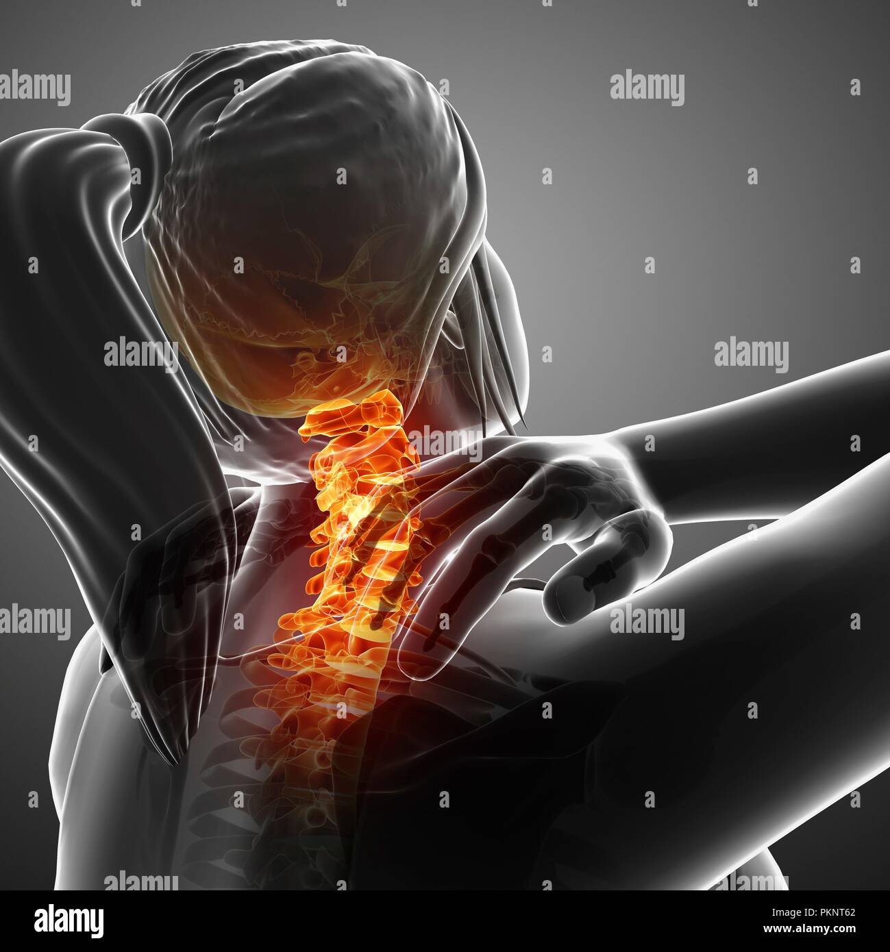 Woman with neck pain, computer illustration Stock Photo - Alamy