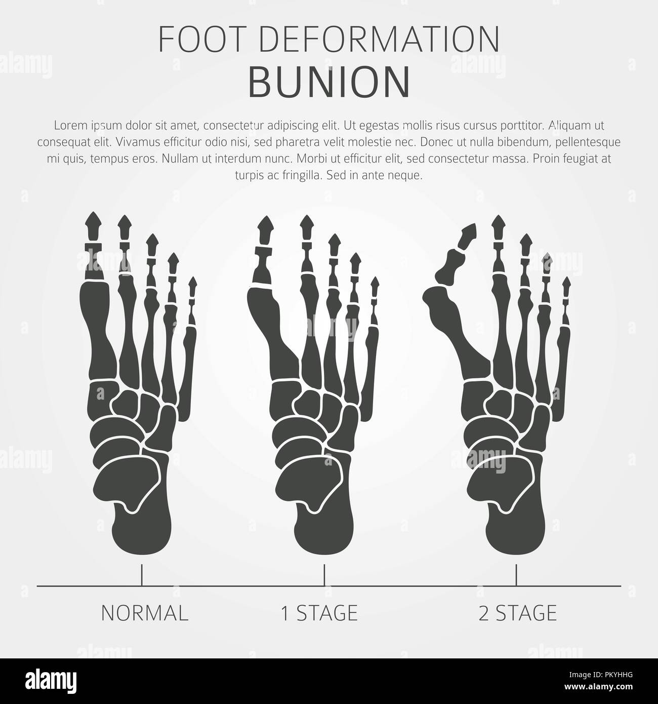 Foot deformation as medical desease infographic. Causes of bunion ...