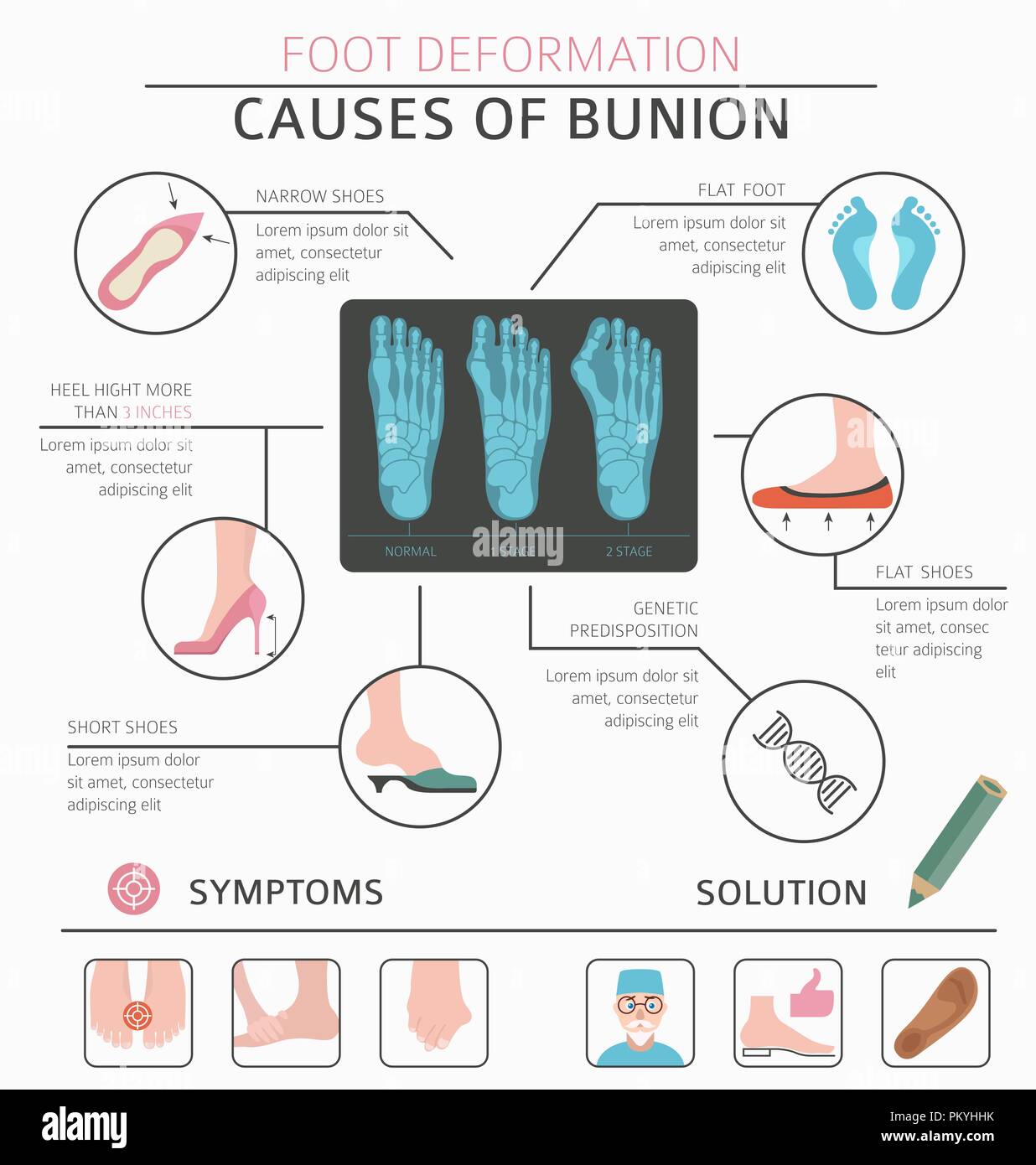 Bone deformity toe Stock Vector Images - Alamy