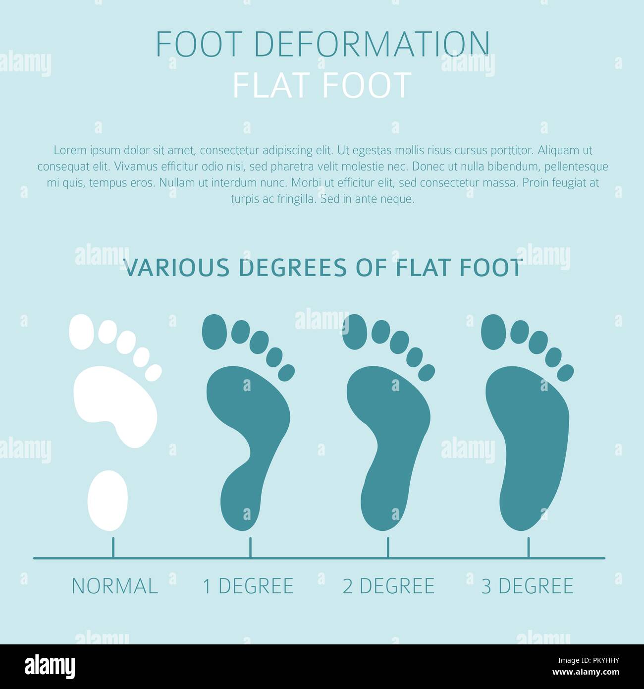 Foot deformation as medical desease infographic. Causes of Flat foot ...