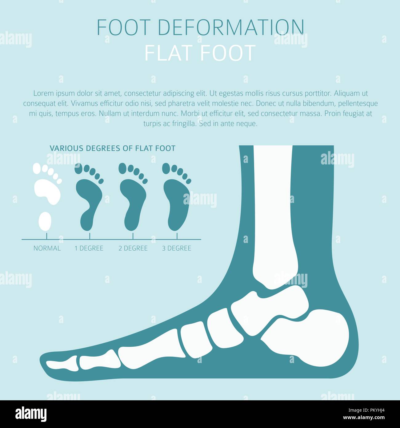 Foot deformation as medical desease infographic. Causes of Flat foot ...