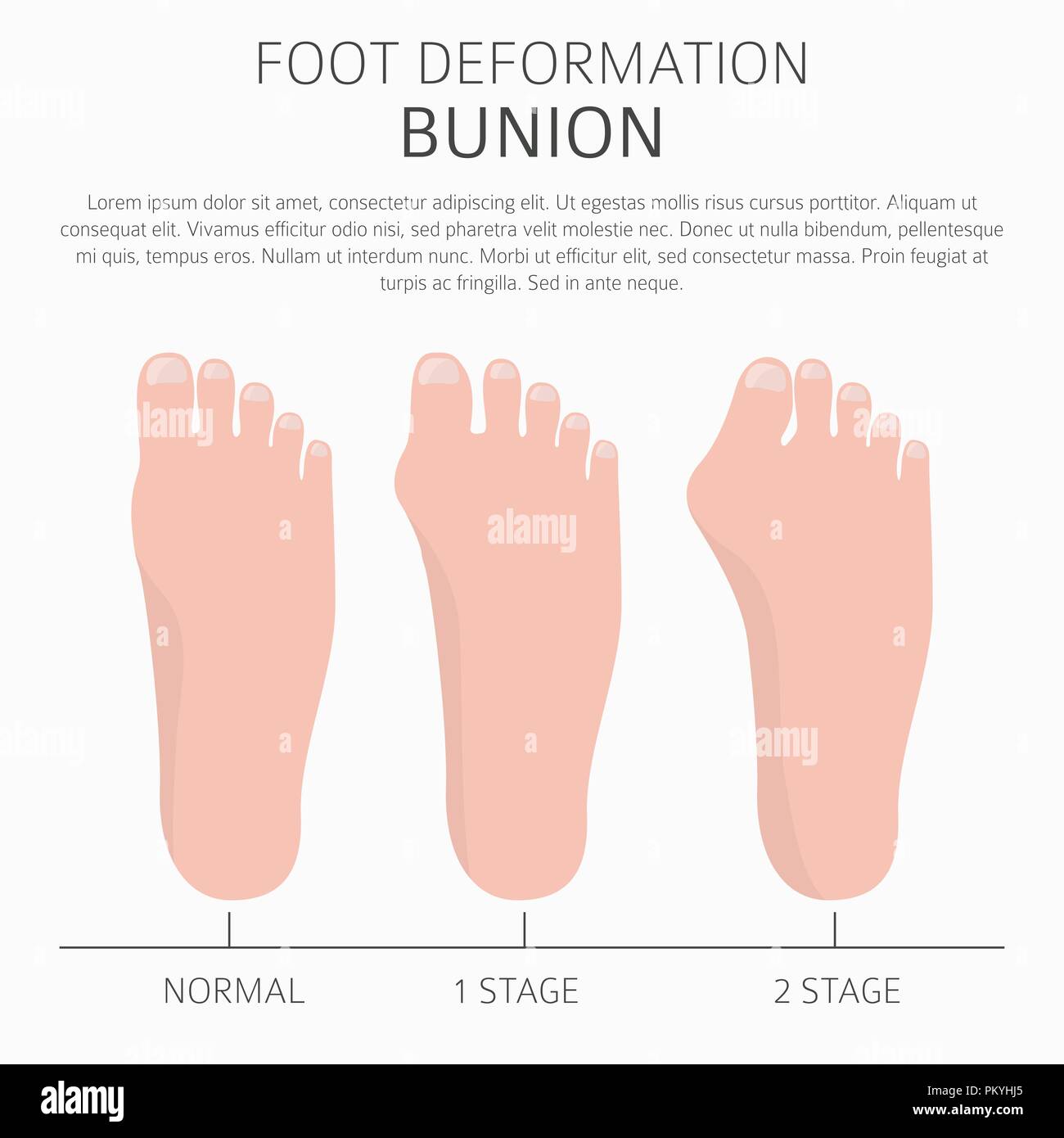 Foot deformation as medical desease infographic. Causes of bunion ...