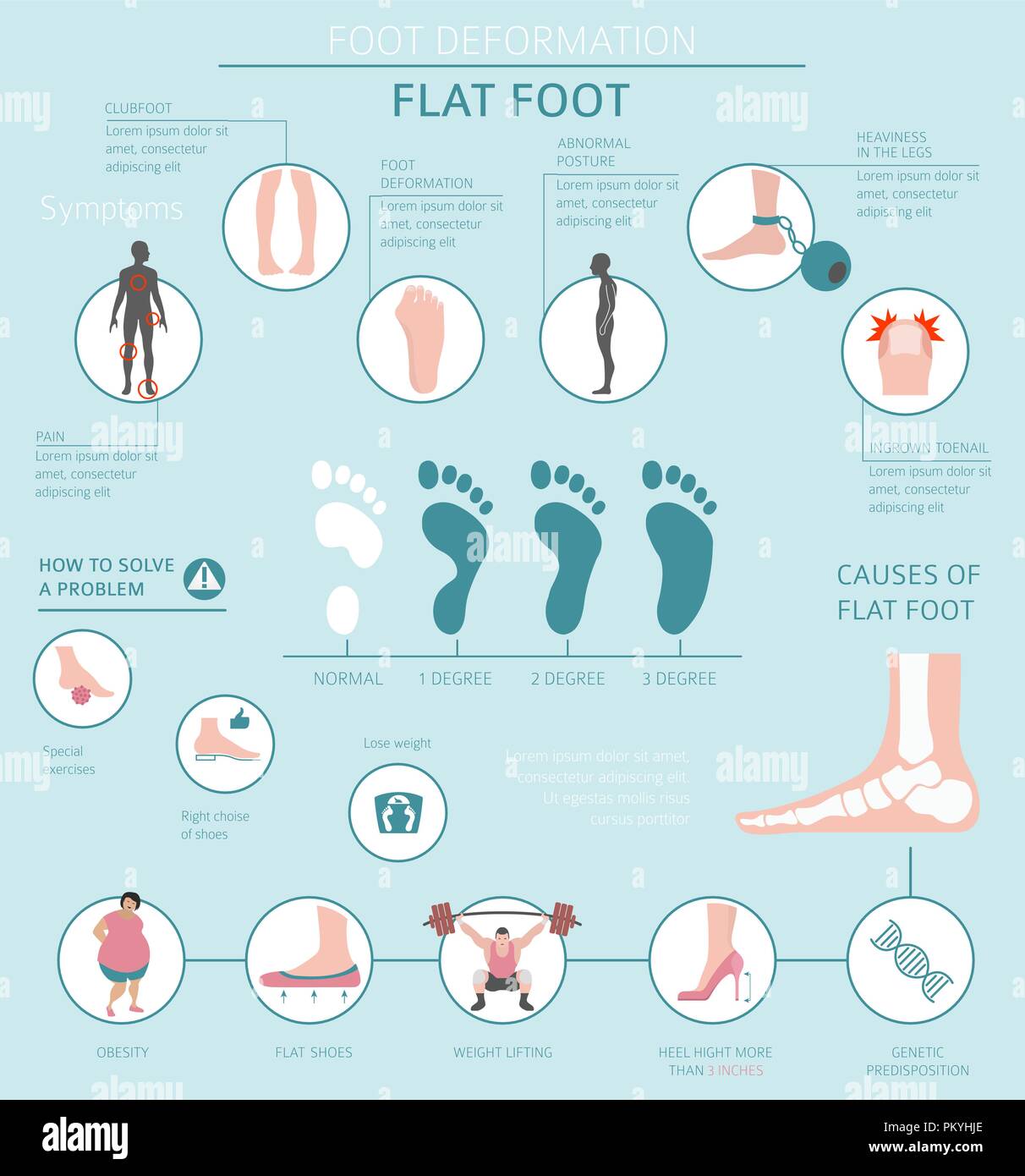Foot deformation as medical desease infographic. Causes of Flat foot ...