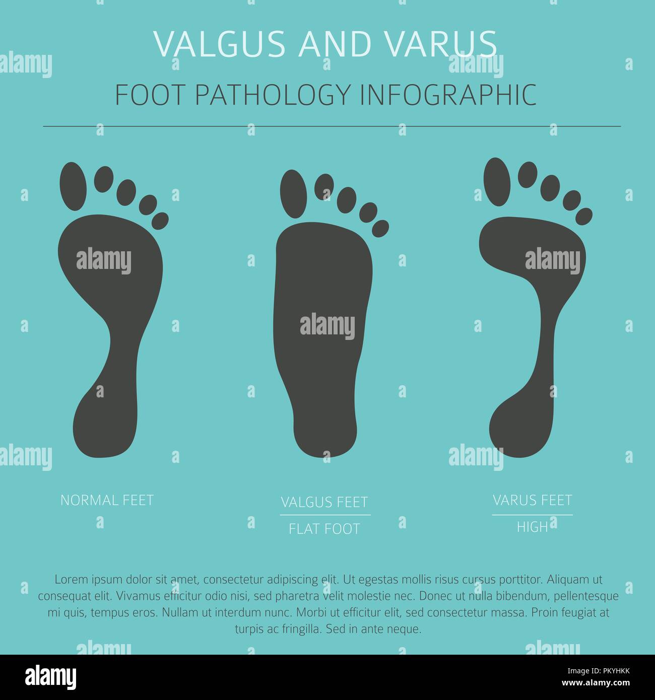 Foot deformation as medical desease infographic. Valgus and varus ...
