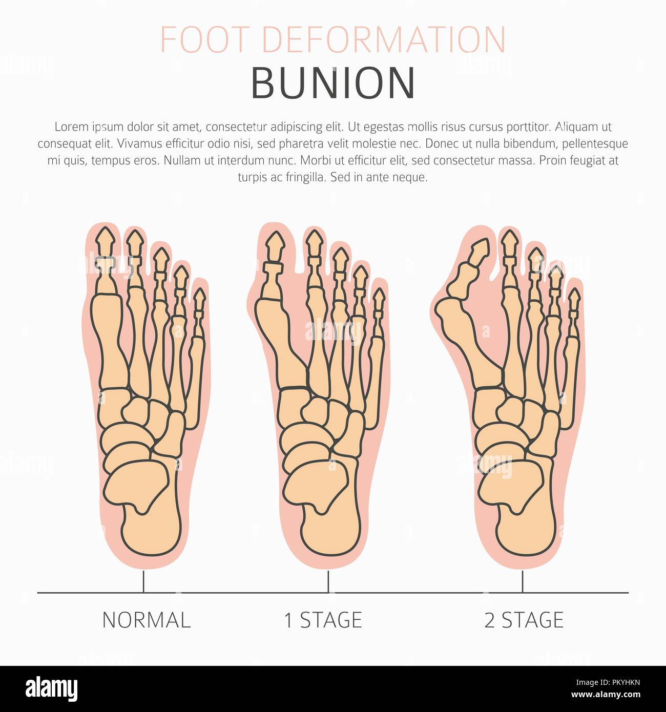 Foot Deformity Stock Photos & Foot Deformity Stock Images - Alamy