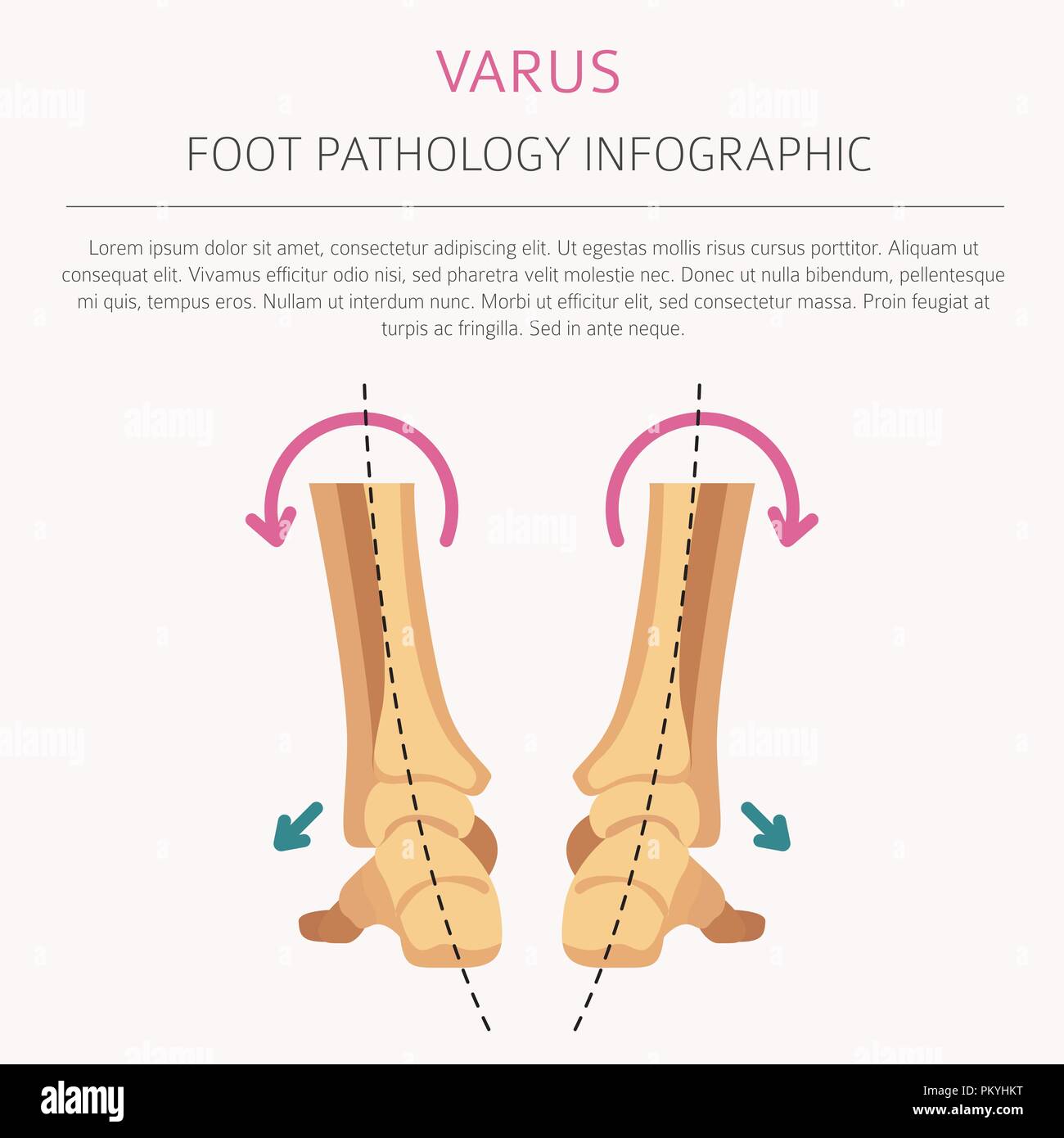Foot deformation as medical desease infographic. Valgus and varus ...