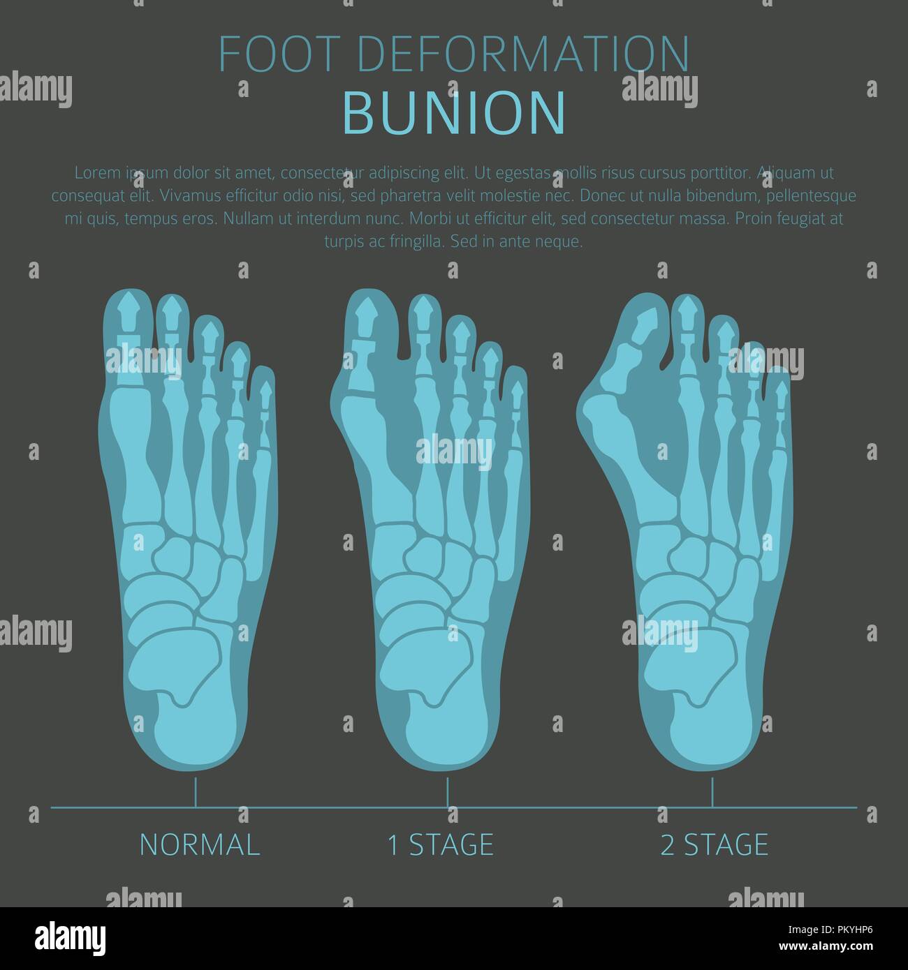Foot deformation as medical desease infographic. Causes of bunion ...