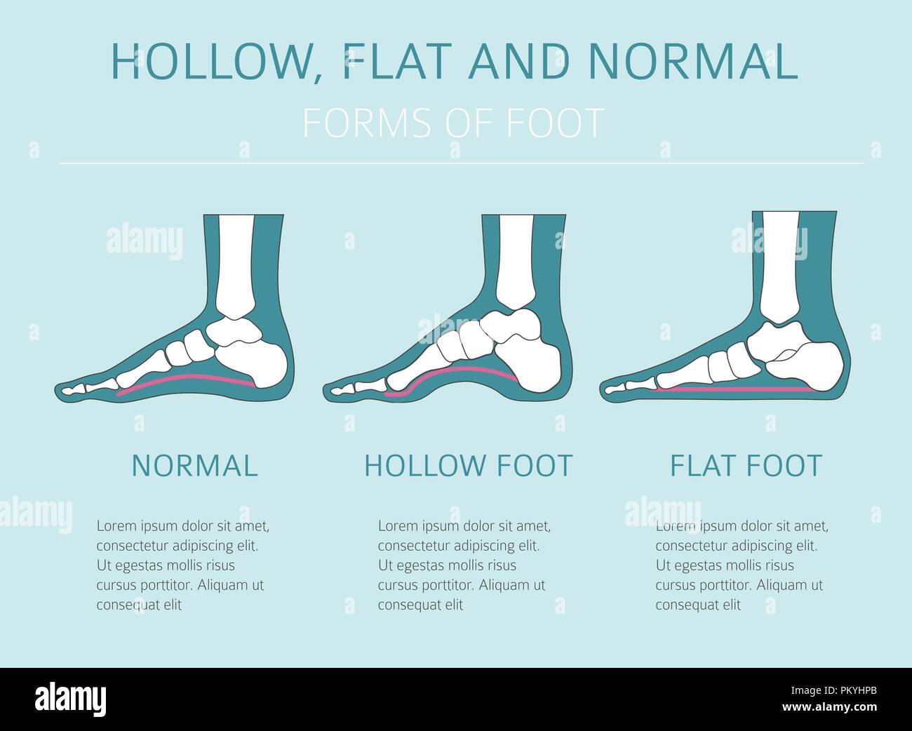 Foot deformation types, medical desease infographic. Hollow, flat and ...