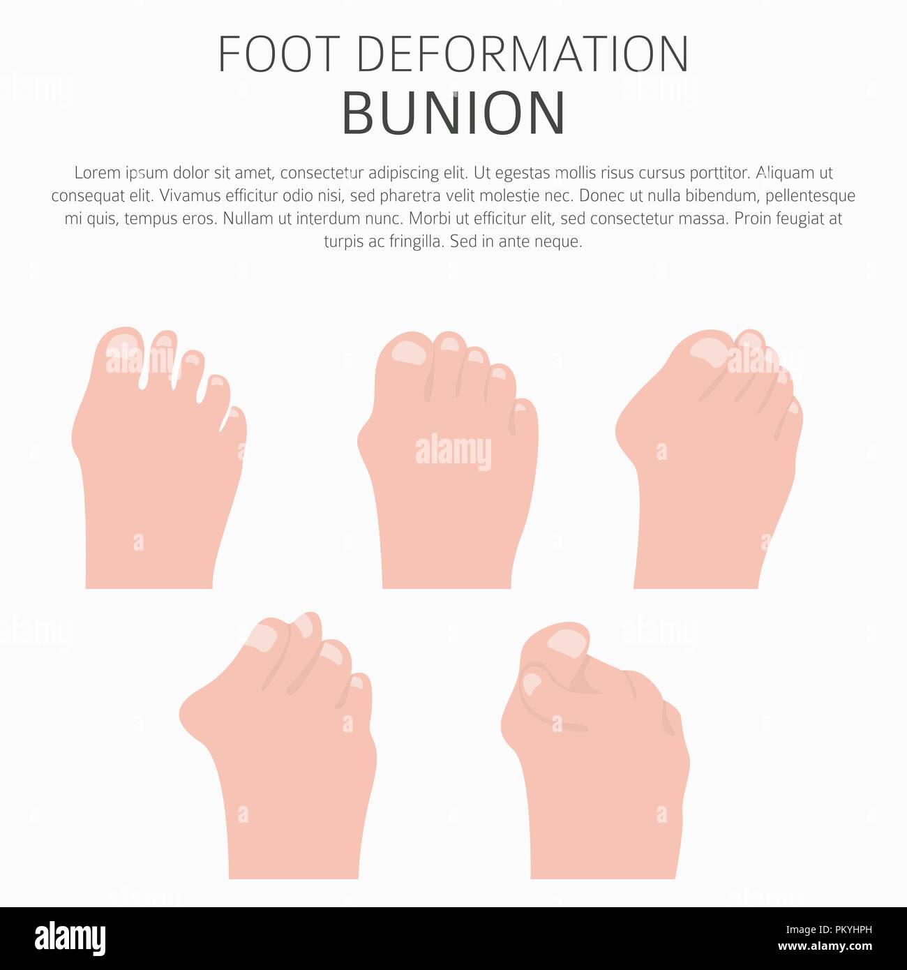 Foot deformation as medical desease infographic. Causes of bunion ...