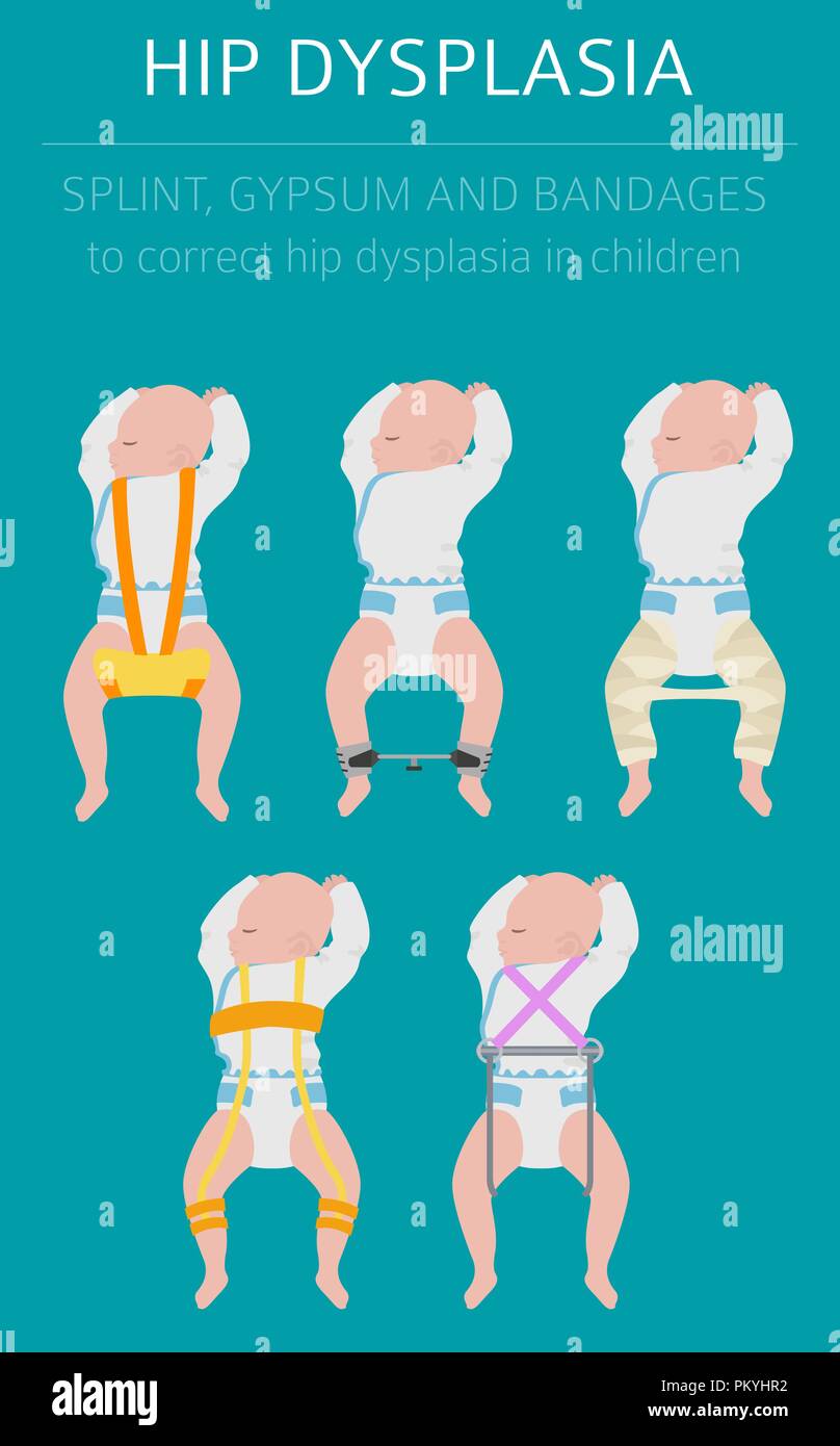 Foot deformation types, medical desease infographic. Hip dysplasia in ...