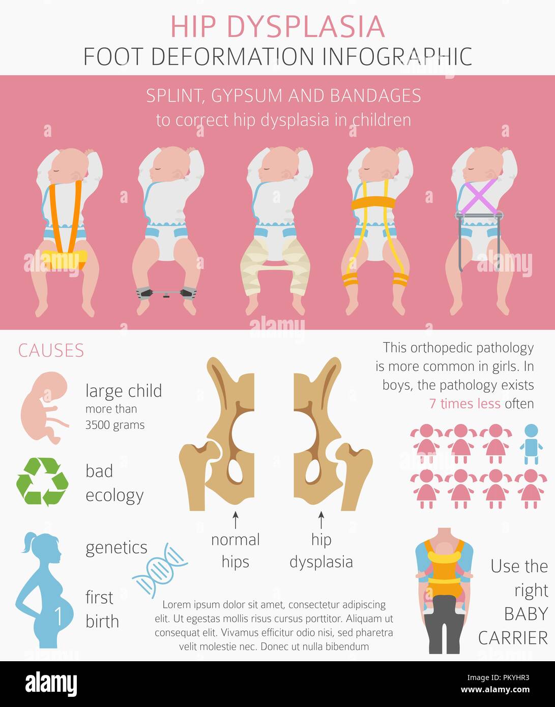 Types Of Hip Dysplasia at Christopher Schauer blog