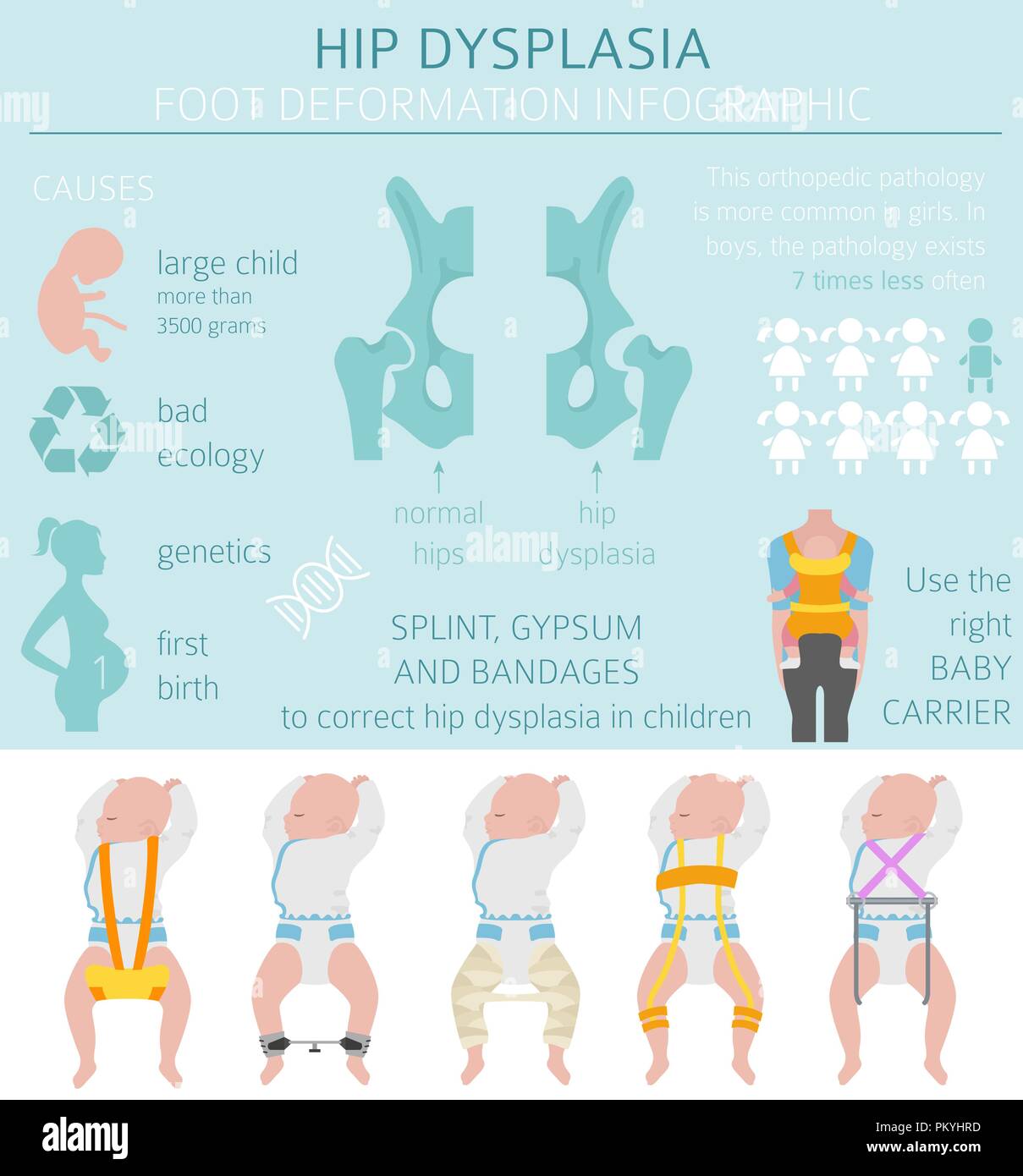 Foot deformation types, medical desease infographic. Hip dysplasia in ...