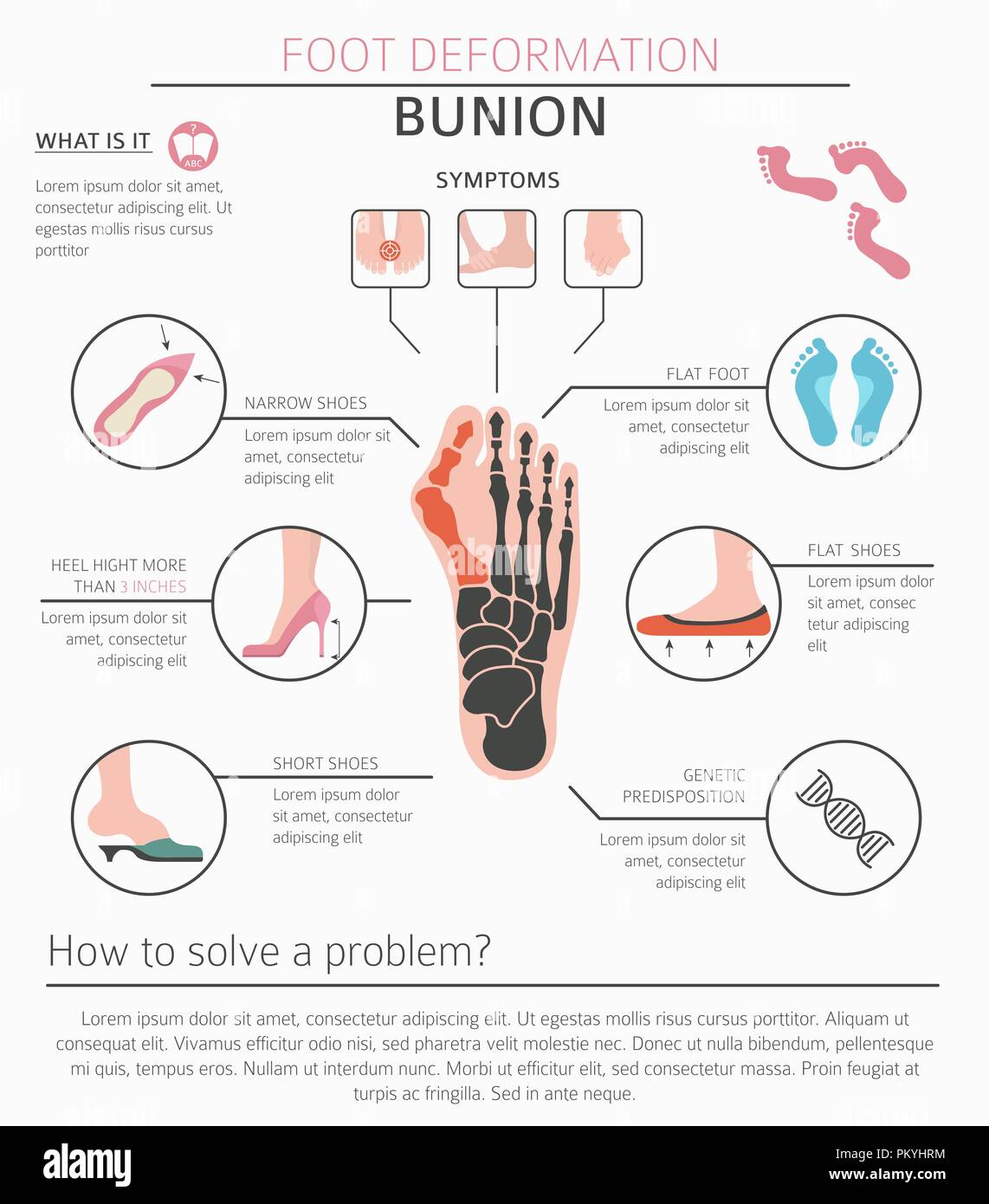 Bunion deformity Stock Vector Images - Alamy