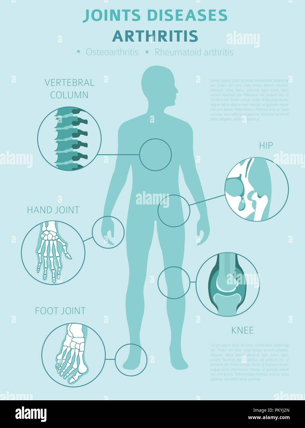 Joints diseases. Arthritis symptoms, treatment icon set. Medical ...