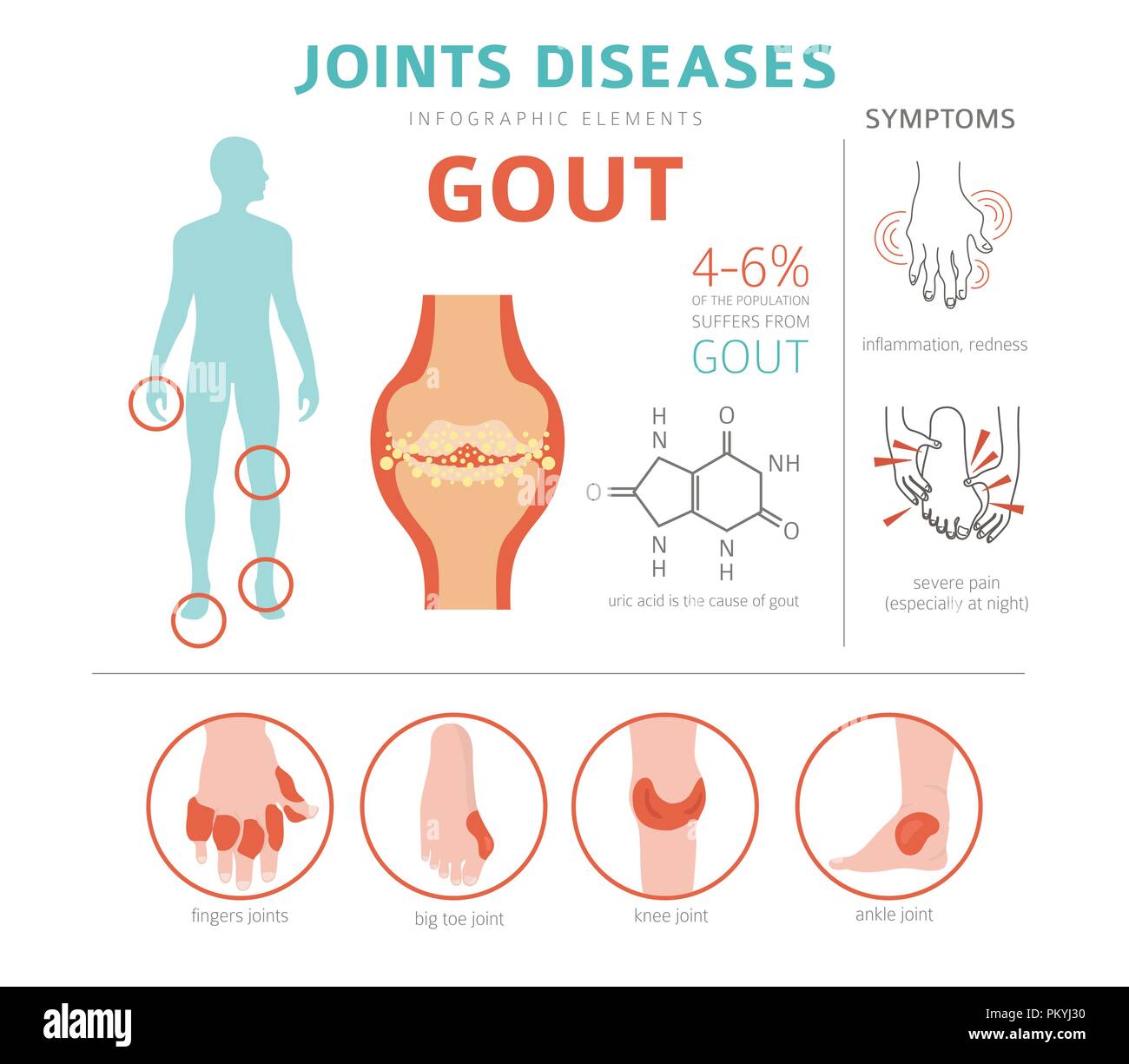Joints diseases. Gout symptoms, treatment icon set. Medical infographic design. Vector ...