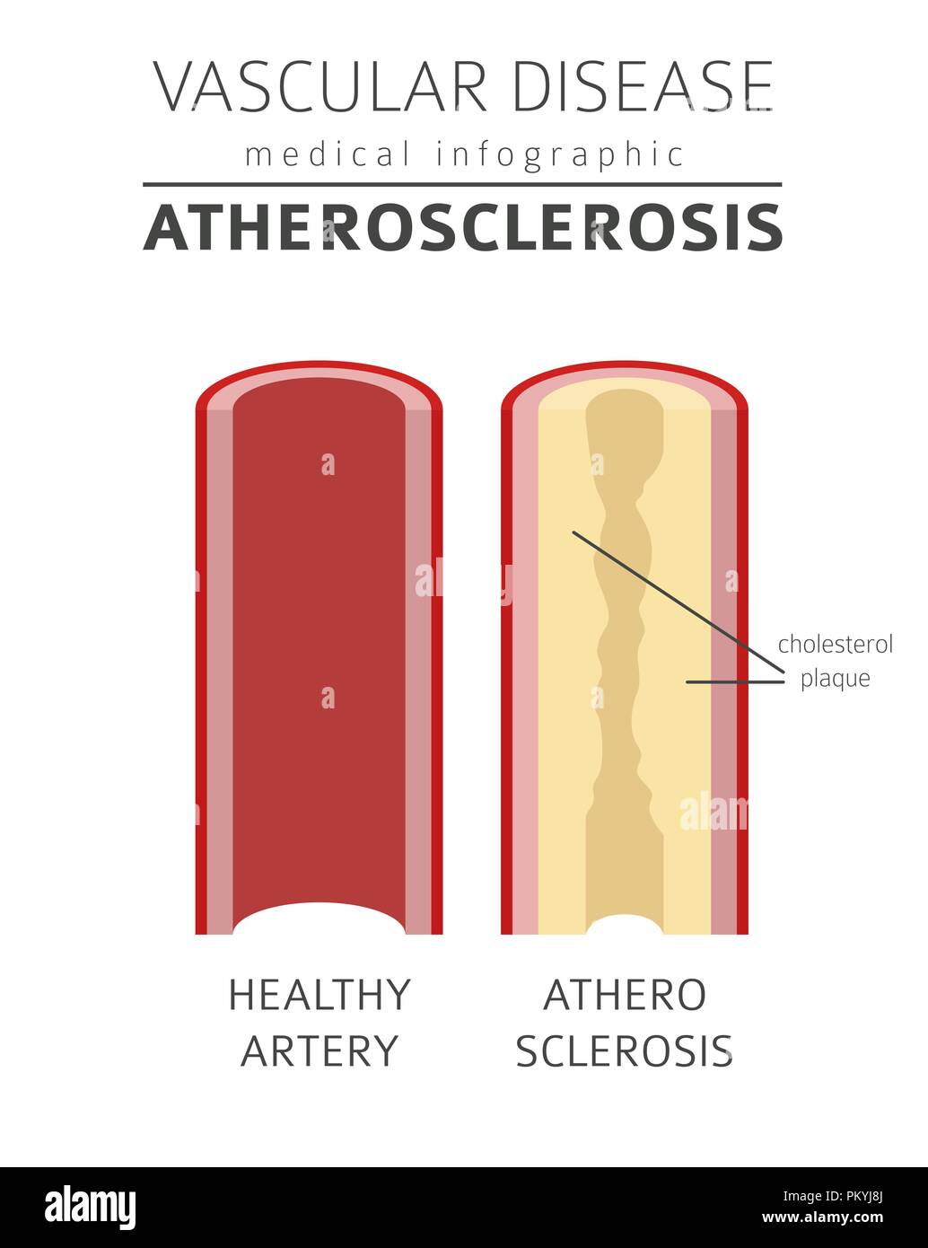 Vascular Diseases Atherosclerosis Symptoms Treatment Icon Set