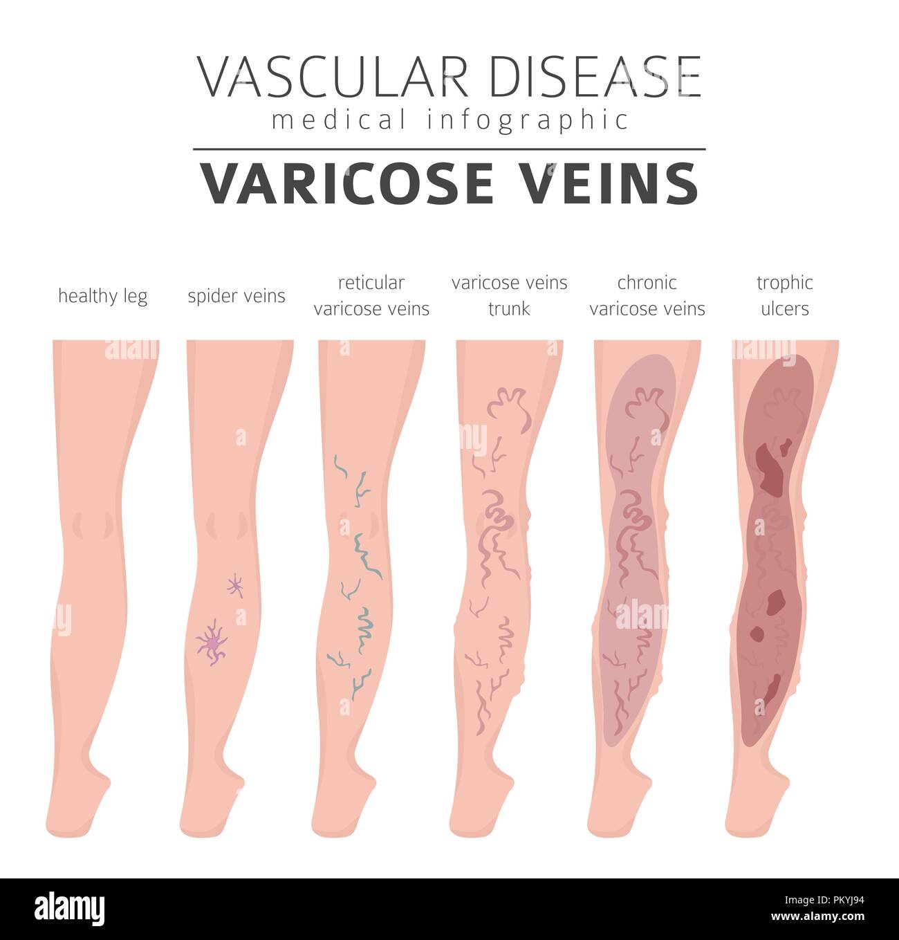 Vascular diseases. Varicose veins symptoms, treatment icon set. Medical infographic design ...