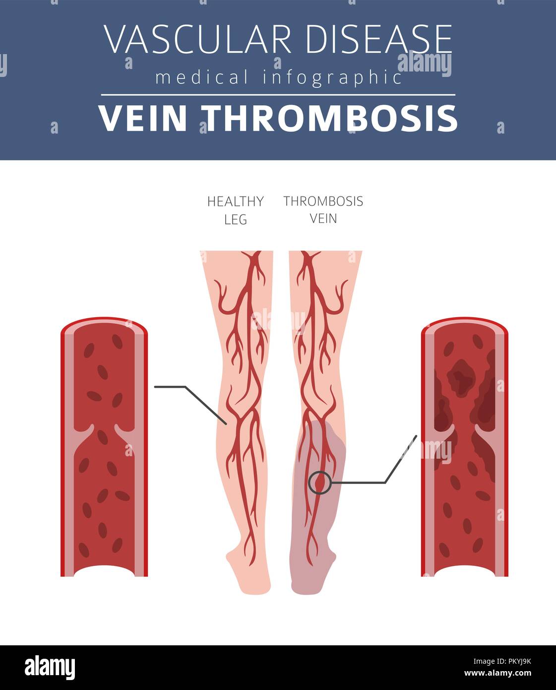 Vascular diseases. Vein thrombosis symptoms, treatment icon set ...