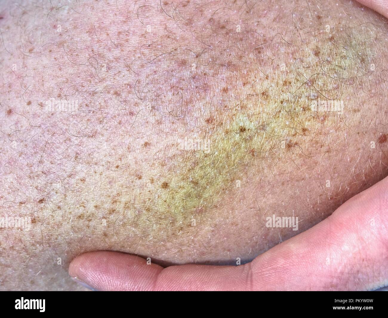 Large colorful bruise on human body. Painful hurt place after sporty ...