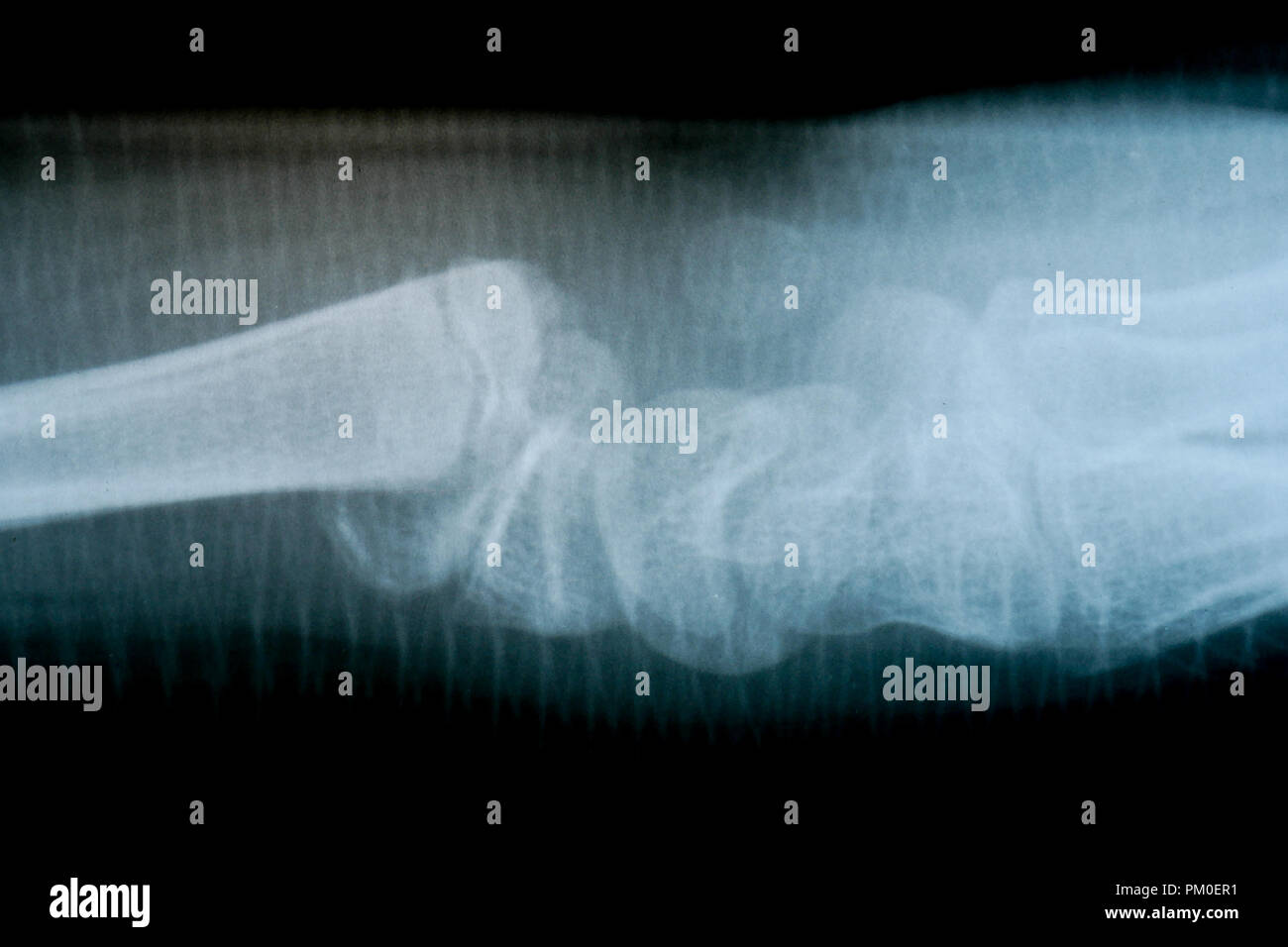 x-ray film skeleton human arm. health medical anatomy body concept ...